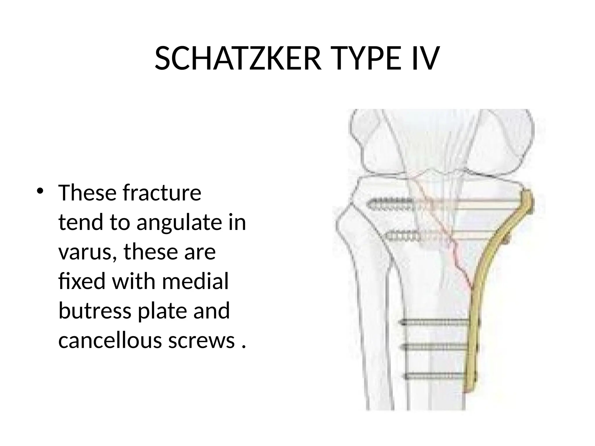 tibial plateau fracture and its management.pptx