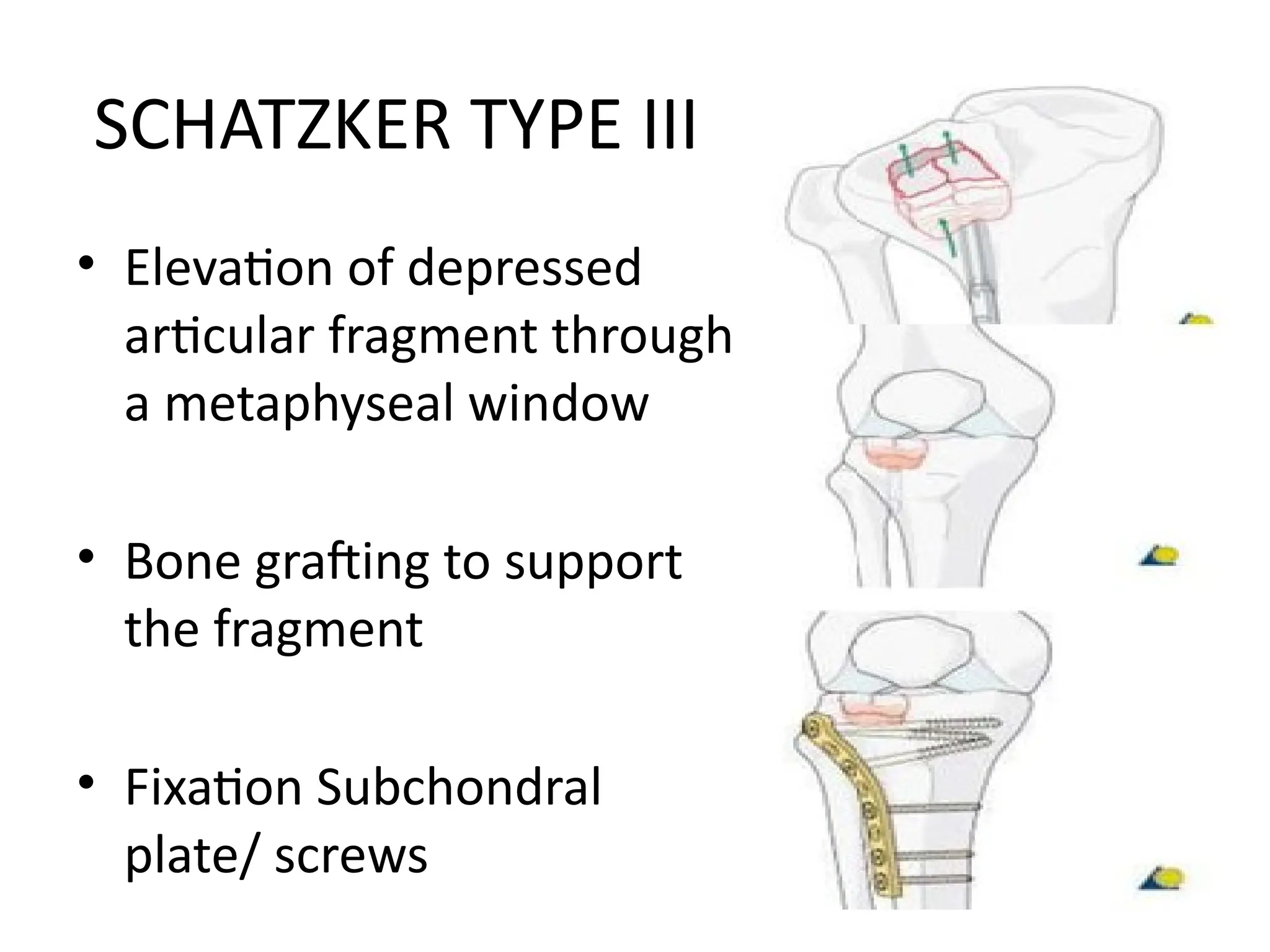 tibial plateau fracture and its management.pptx