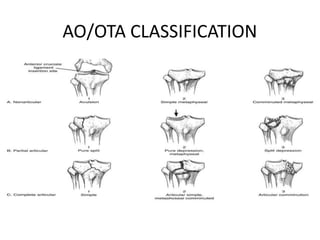 tibial plateau fracture and its management.pptx