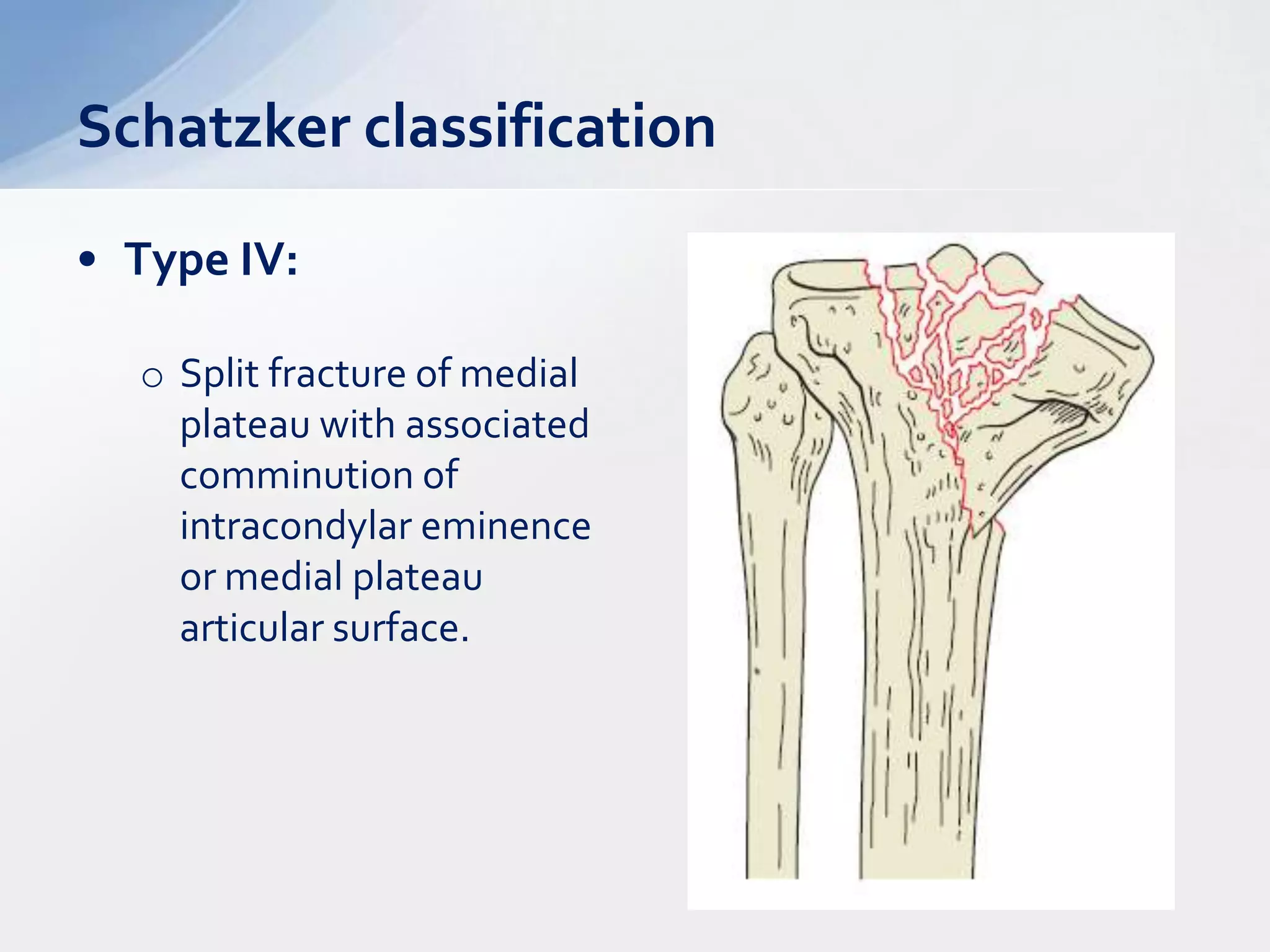 Tibial plateau fractures | PPTX