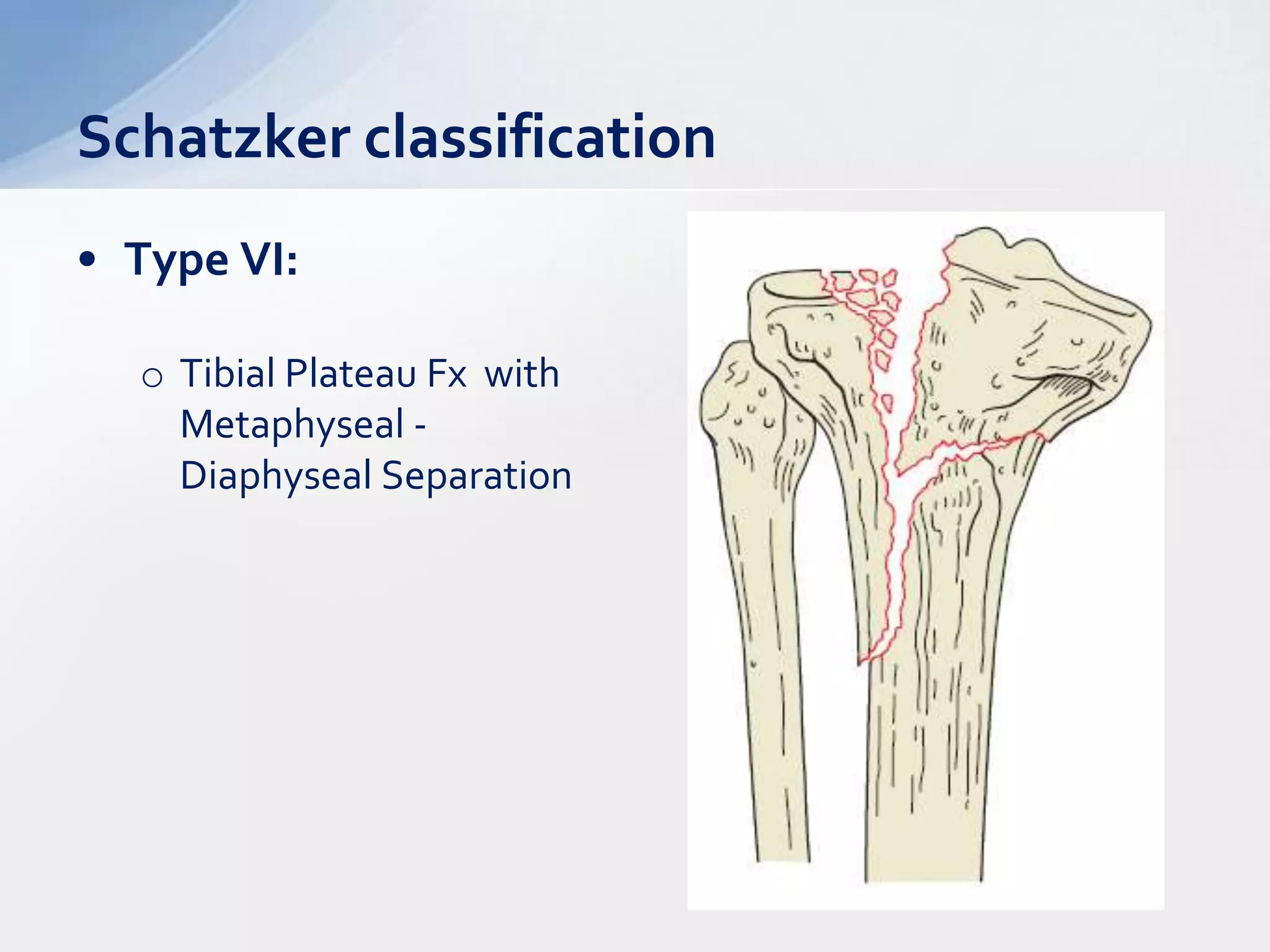 Tibial plateau fractures | PPTX