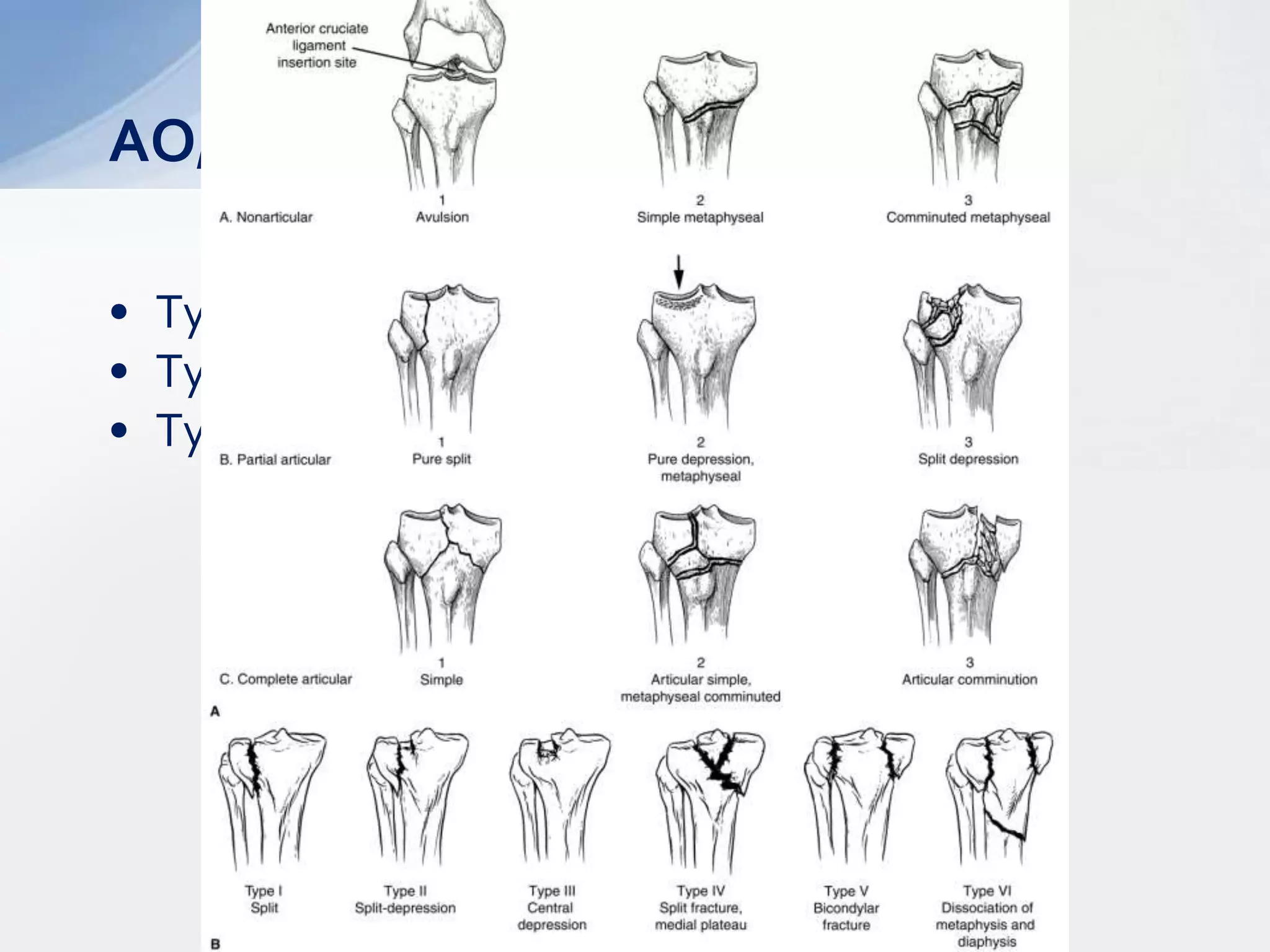 Tibial plateau fractures | PPTX