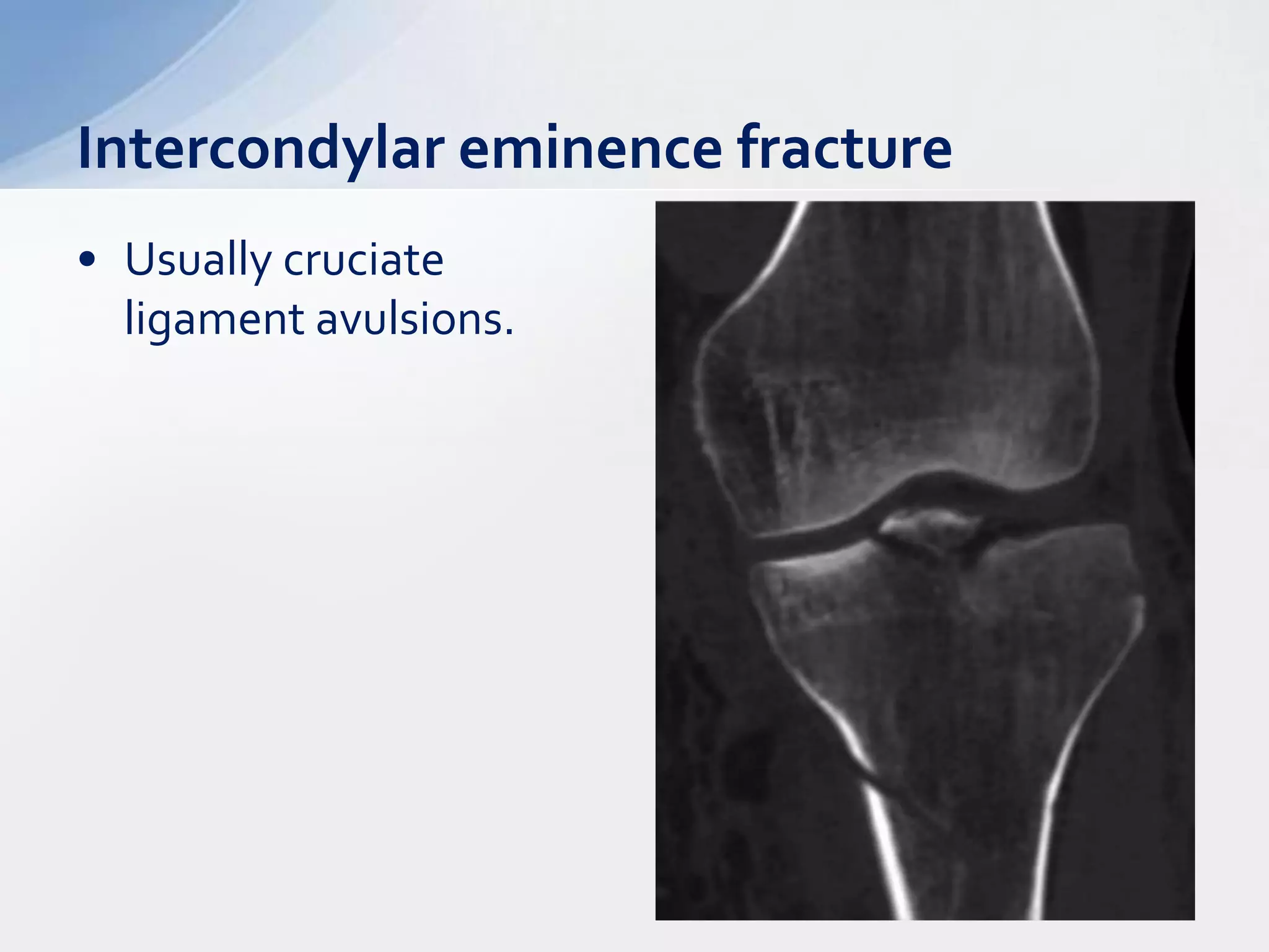 Tibial Plateau Fractures Pptx