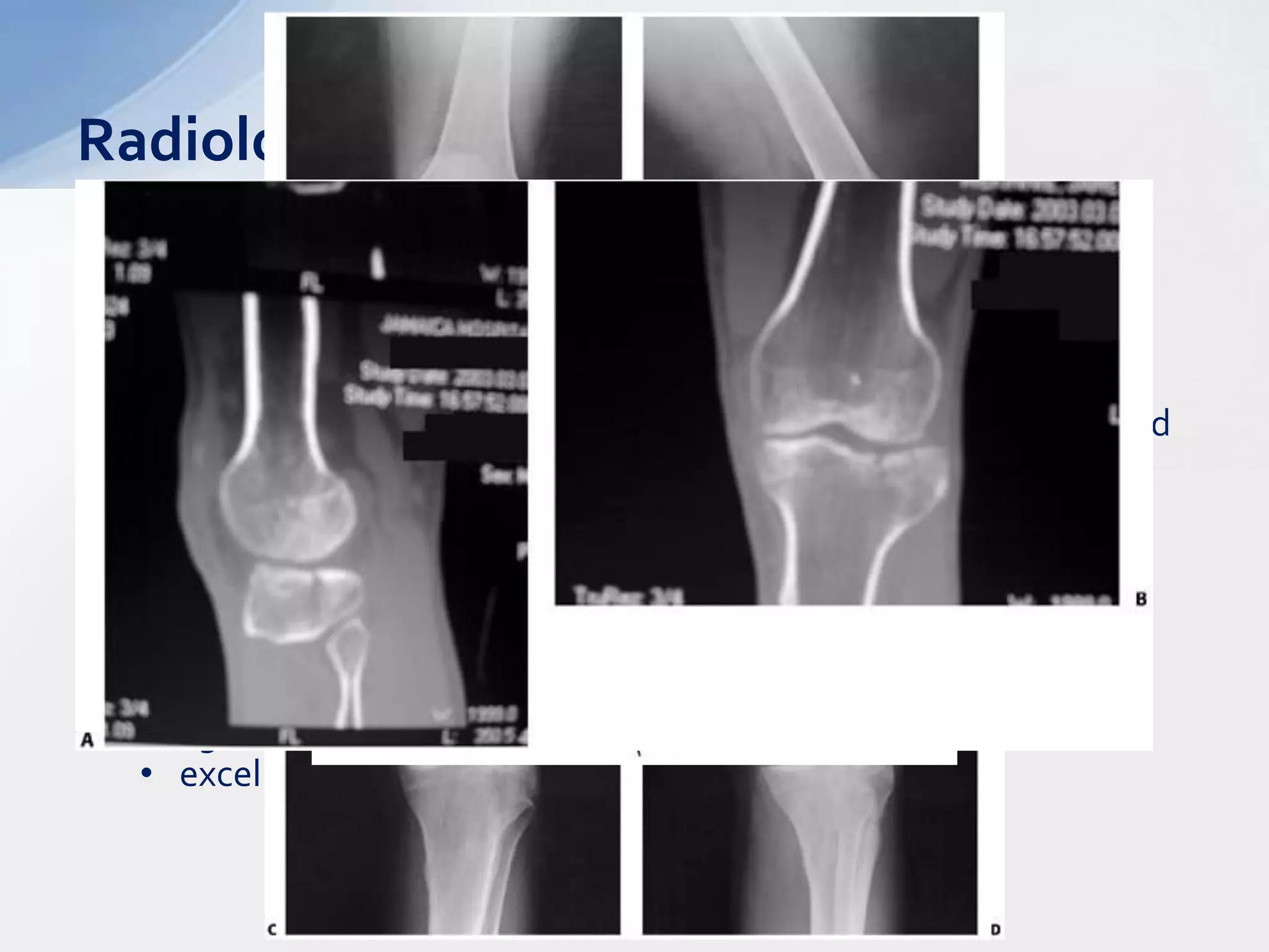 Tibial plateau fractures | PPTX