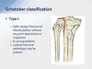 Tibial plateau fractures | PPTX