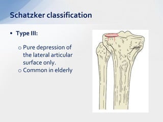 Tibial plateau fractures | PPTX