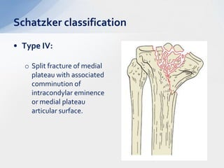 Tibial plateau fractures | PPTX