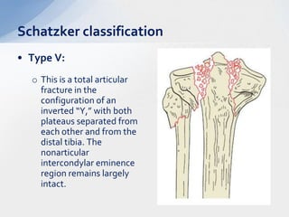 Tibial plateau fractures | PPTX