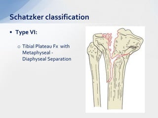 Tibial plateau fractures | PPTX