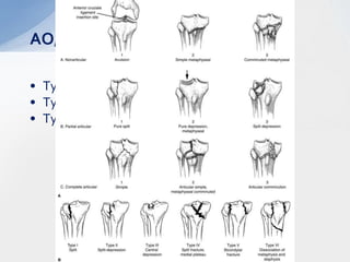 Tibial Plateau Fracture Classification
