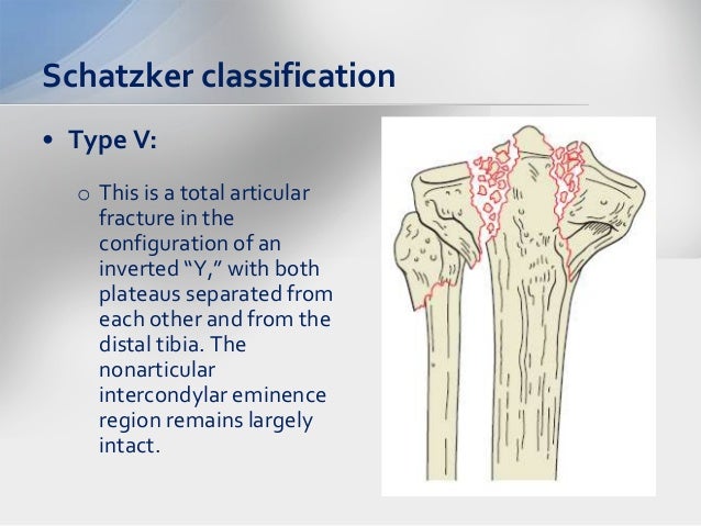 Tibial plateau fractures