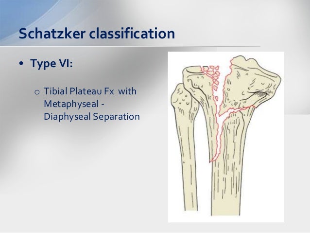 Schatzker Classification