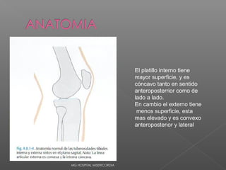 FRACTURAS DE TIBIA PROXIMAL | PPT