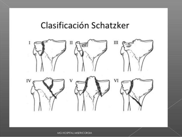 FRACTURAS DE TIBIA PROXIMAL