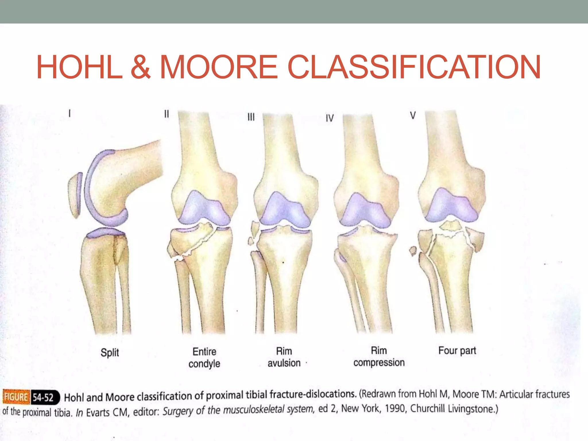 Tibial plateau fractures | PPTX