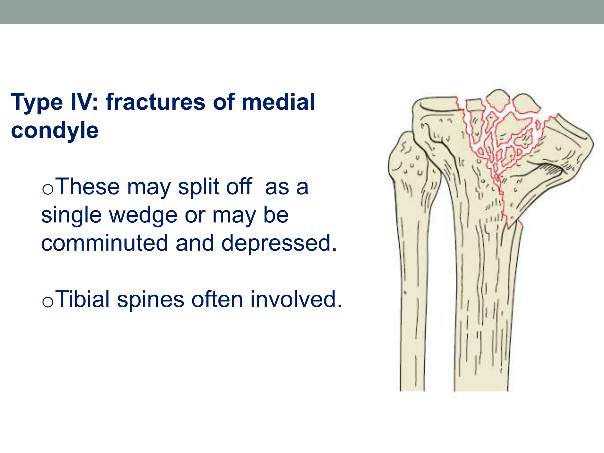 Tibial plateau fractures | PPTX
