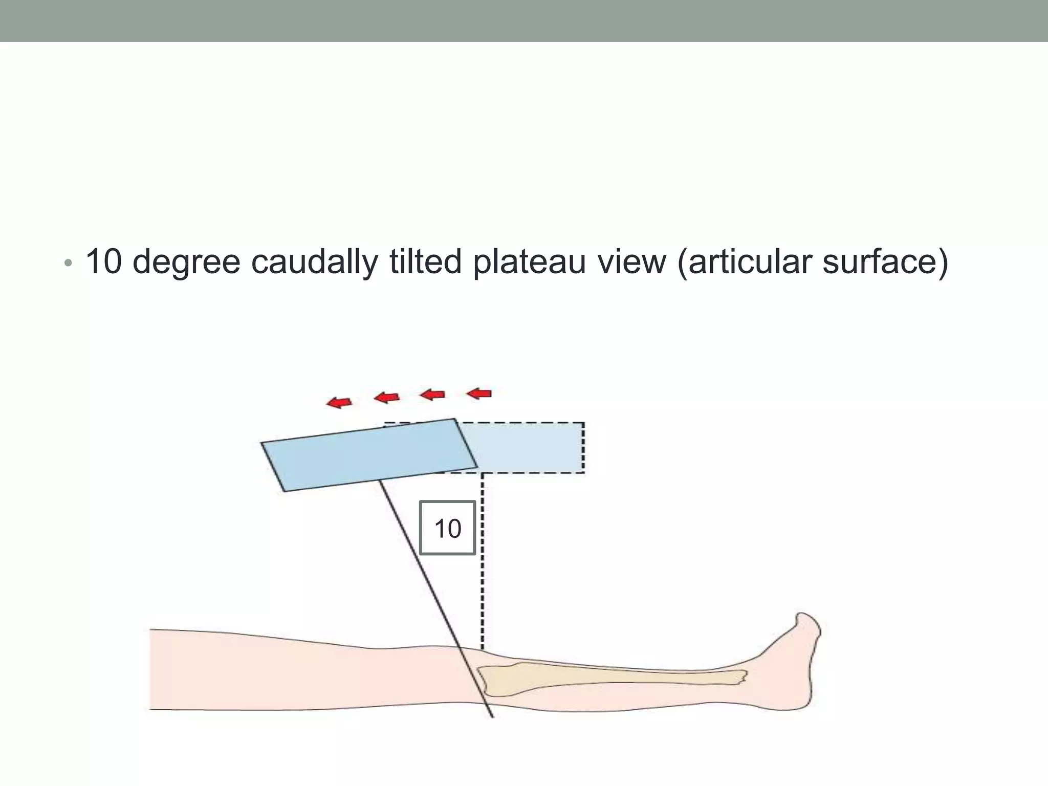 Tibial plateau fractures | PPTX