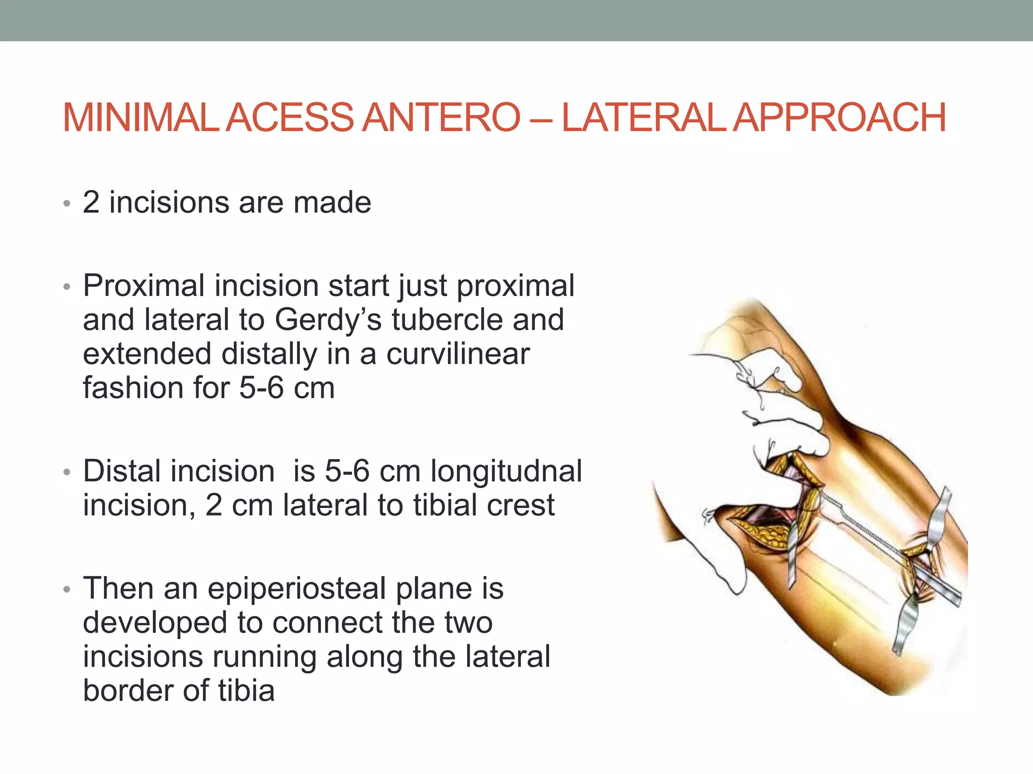 Tibial plateau fractures | PPTX