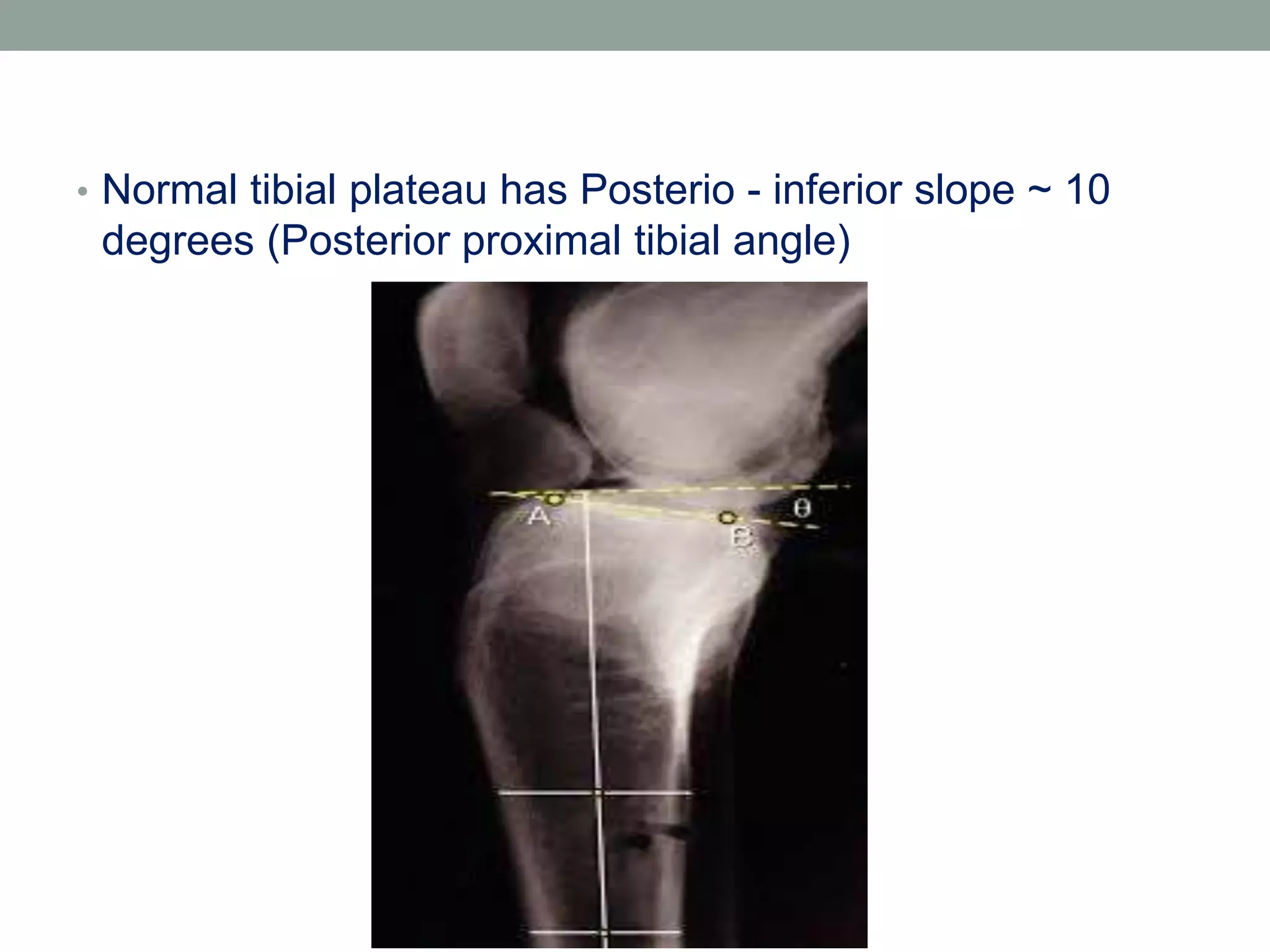 Tibial plateau fractures | PPTX