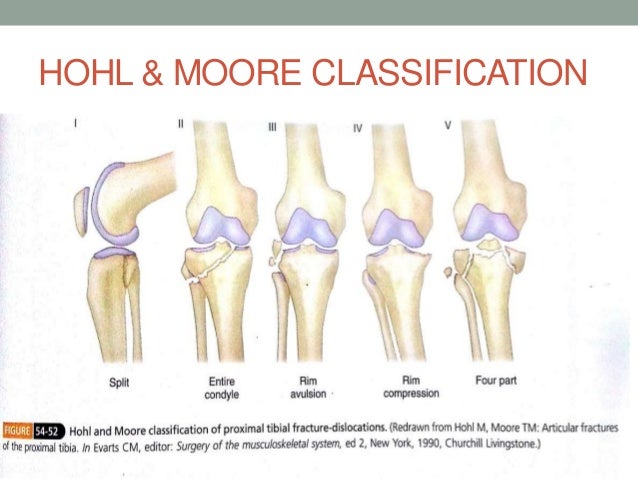 Tibial plateau fractures