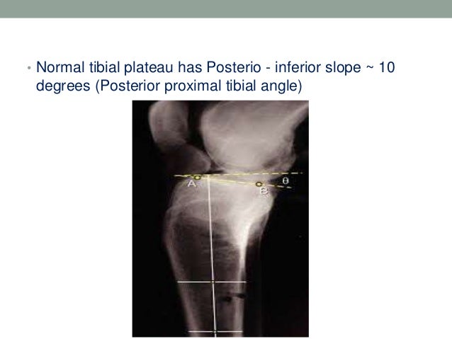 Tibial plateau fractures