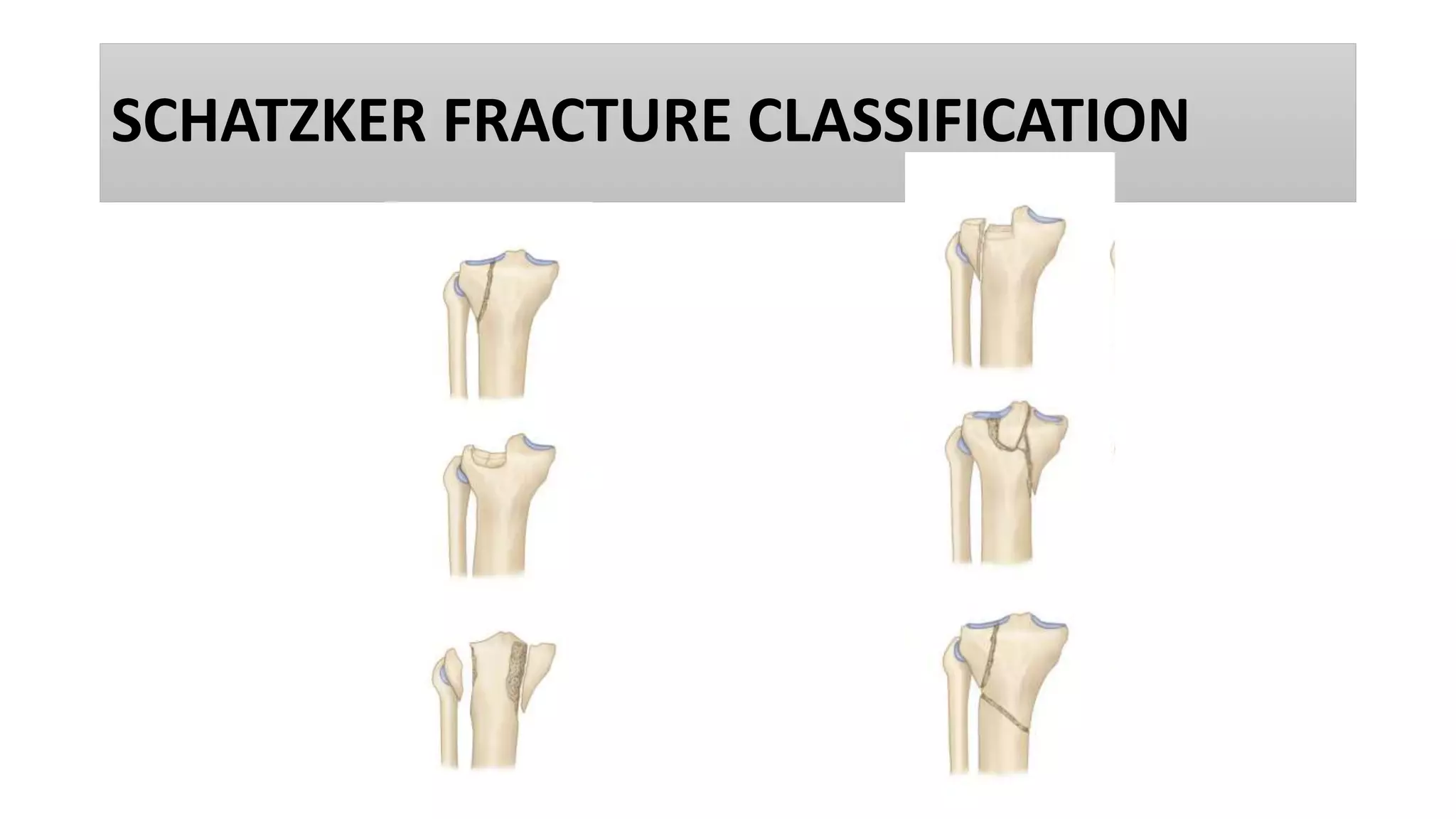 Tibial plateau fractures | PPTX