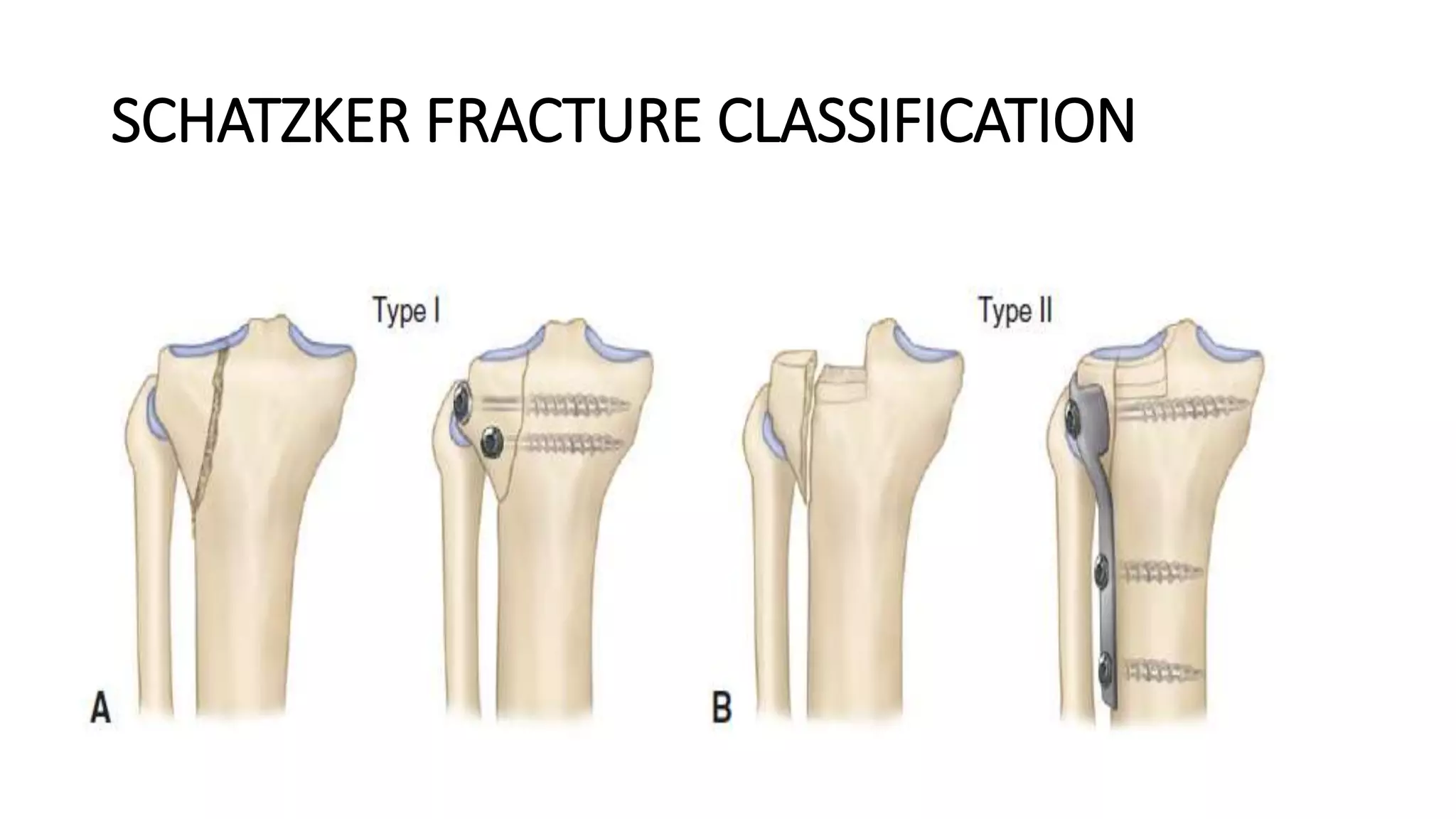 Tibial plateau fractures | PPTX