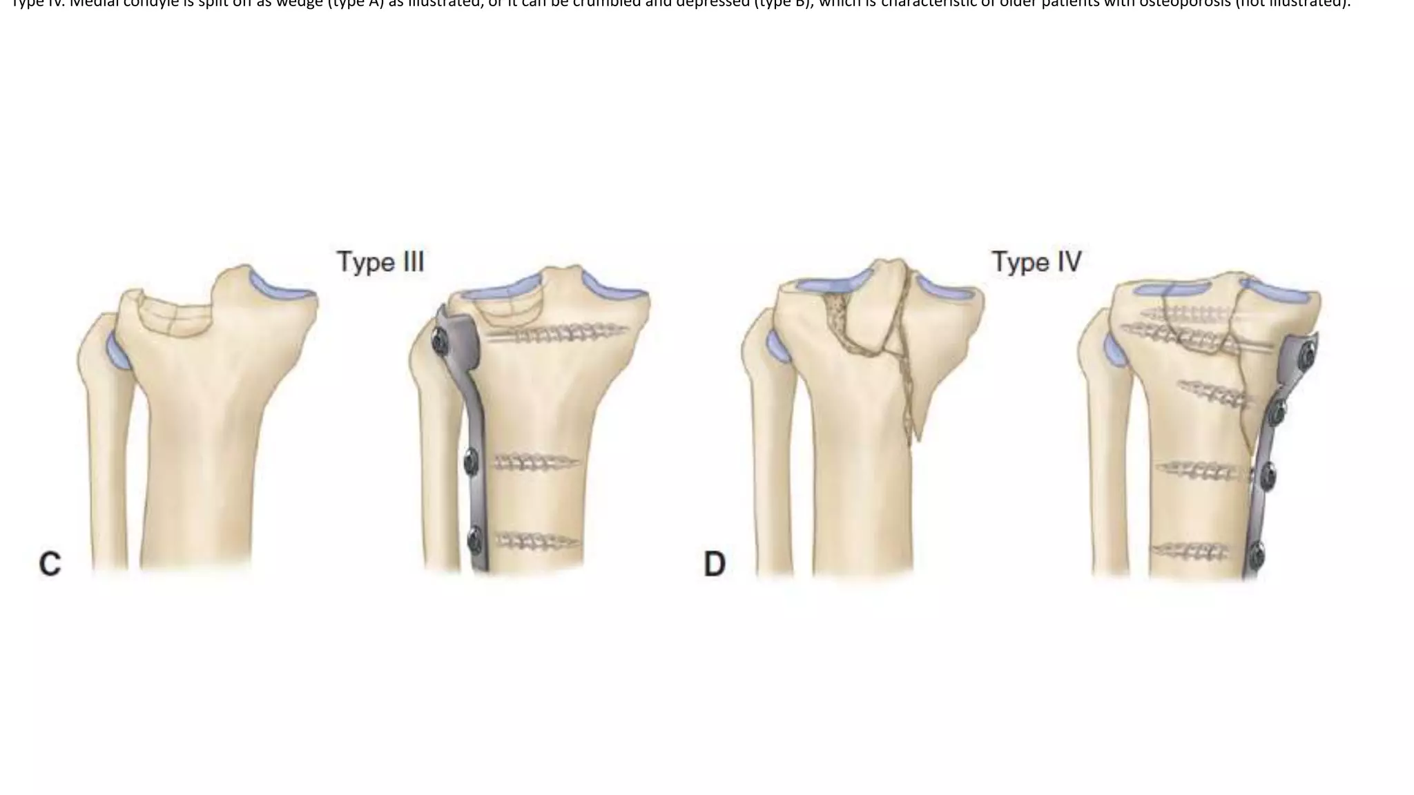 Tibial plateau fractures | PPTX