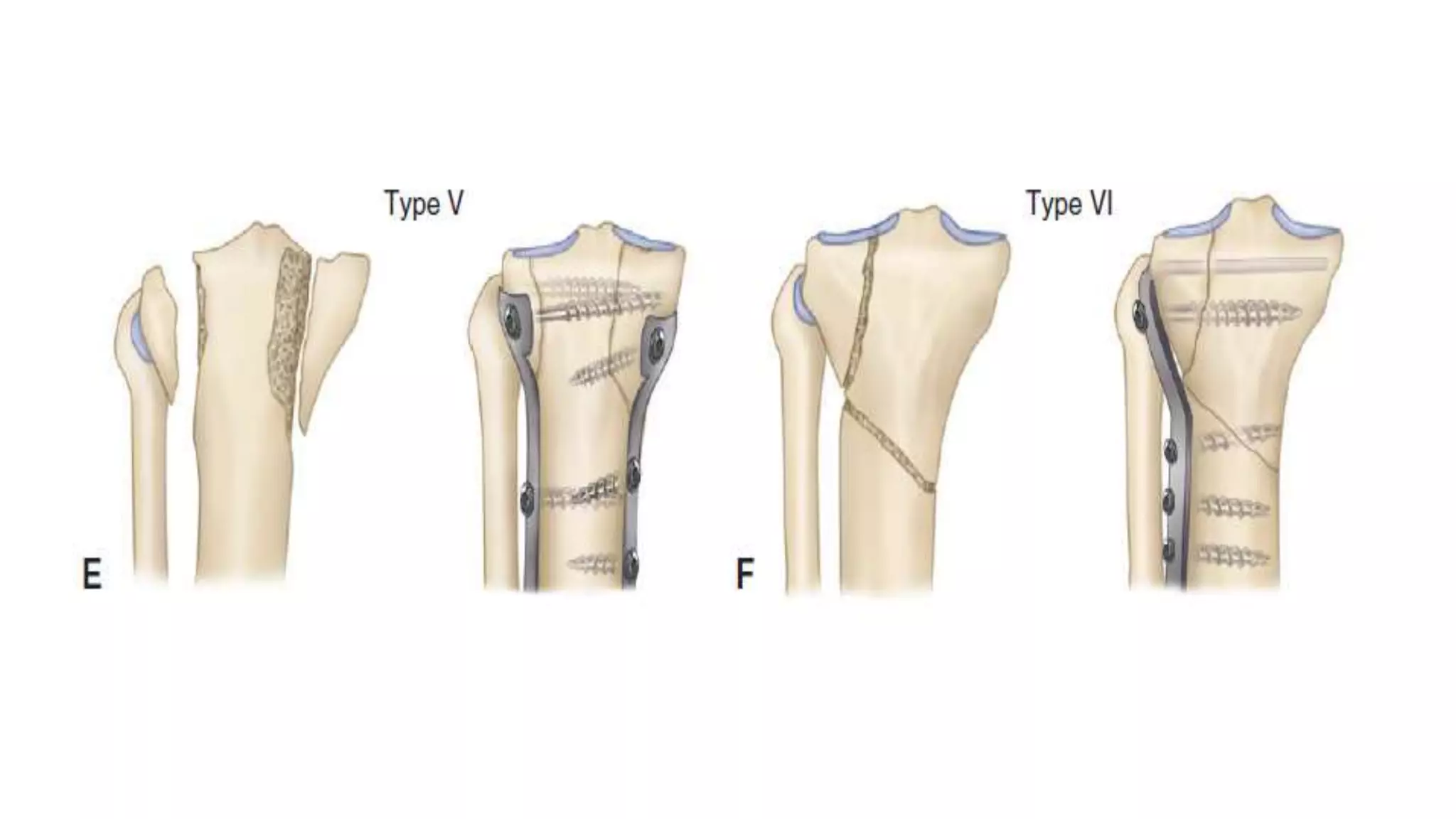 Tibial plateau fractures | PPTX