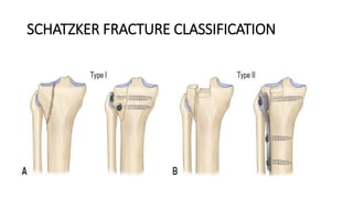 Tibial plateau fractures | PPTX