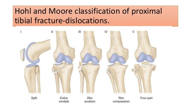 Tibial plateau fractures