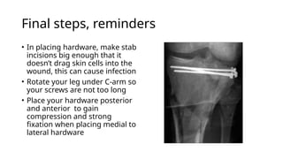 Tibial plateau treatment protocol SCH-1.pptx