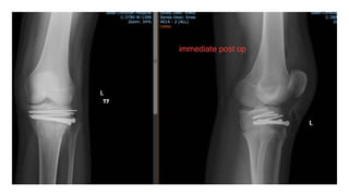 Tibial plateau treatment protocol SCH-1.pptx