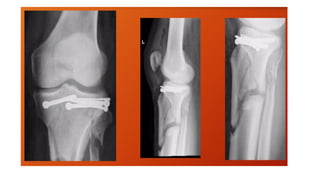 Tibial plateau treatment protocol SCH-1.pptx