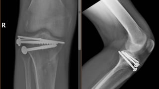 Tibial plateau treatment protocol SCH-1.pptx