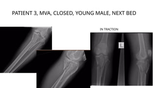 Tibial plateau treatment protocol SCH-1.pptx
