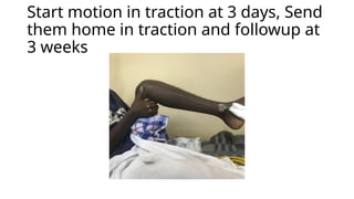 Tibial plateau treatment protocol SCH-1.pptx