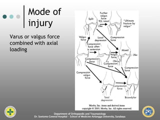 Tibial plateau wdk | PPT