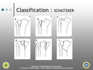 Tibial plateau wdk | PPT