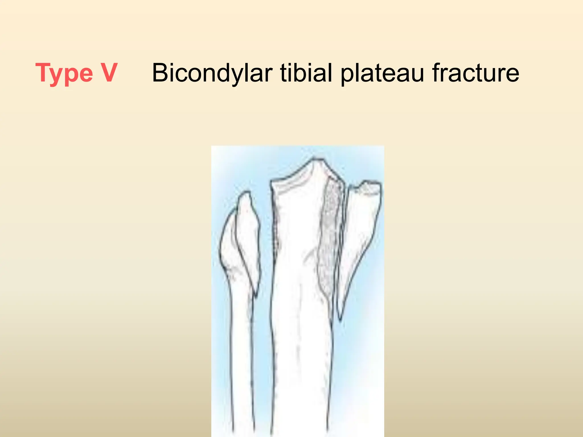 Tibial plateau fracture management .pptx