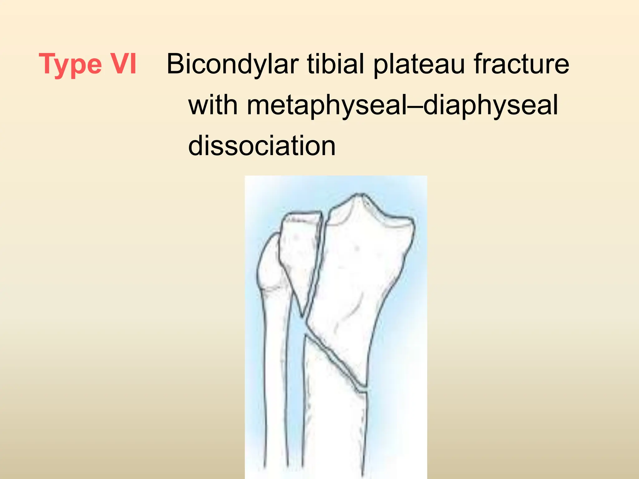Tibial plateau fracture management .pptx