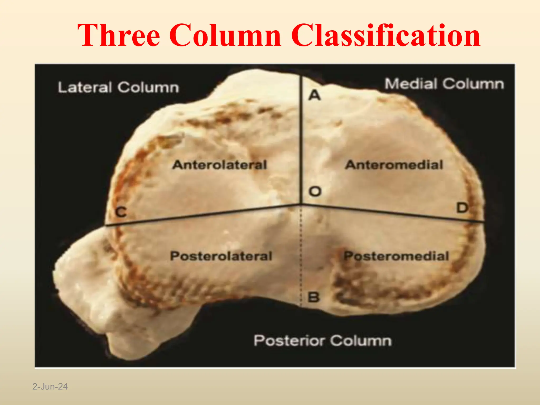 Tibial plateau fracture management .pptx
