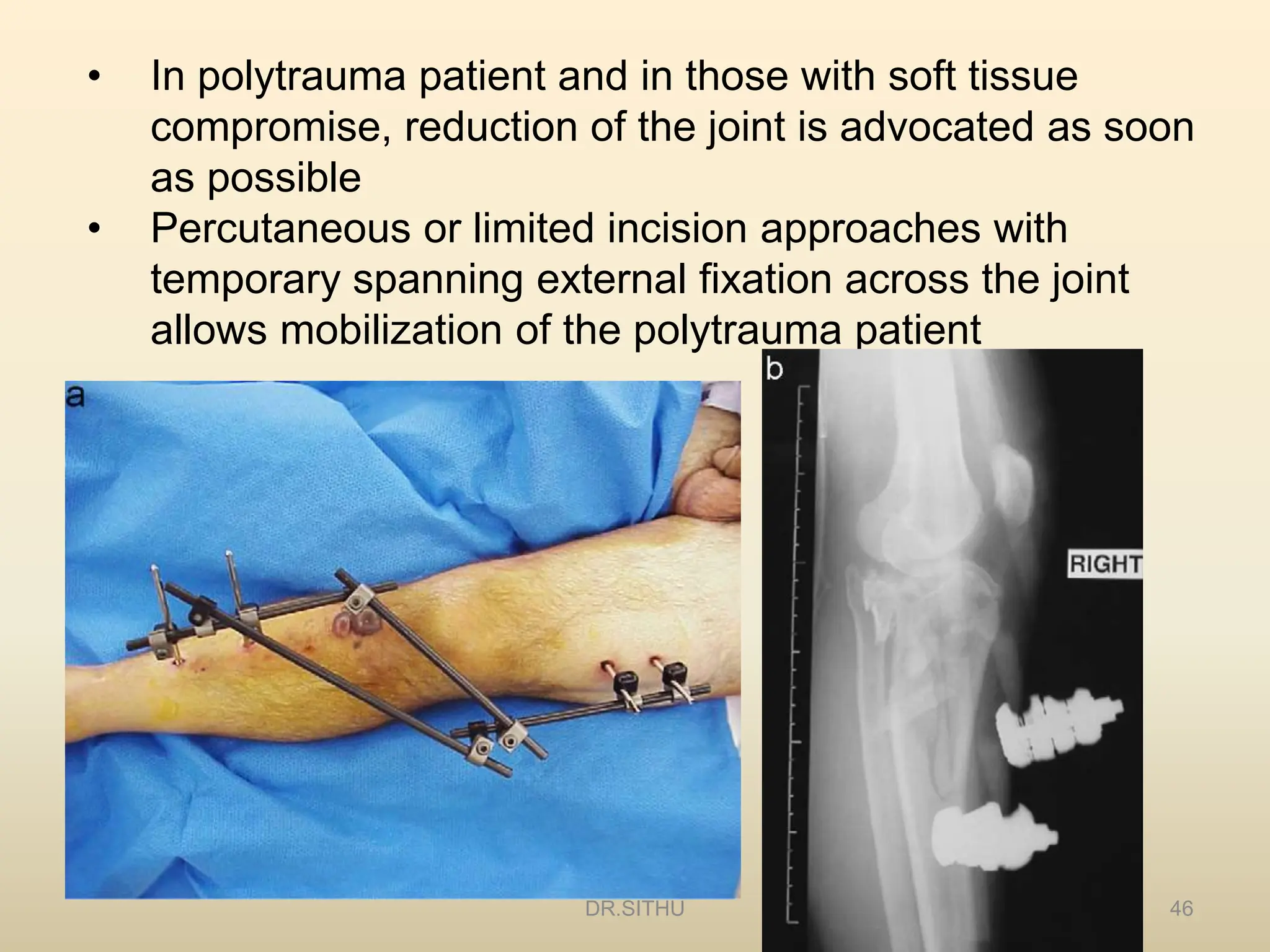 Tibial plateau fracture management .pptx