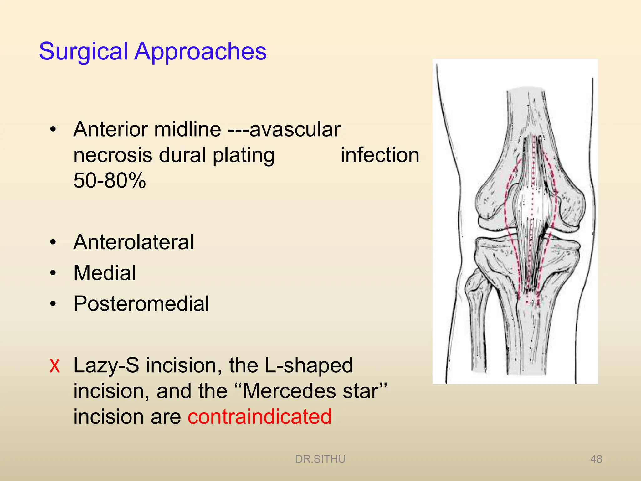 Tibial plateau fracture management .pptx