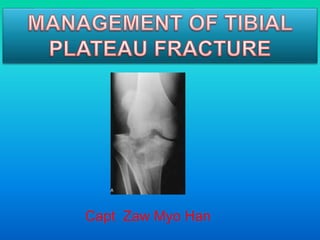 Tibial plateau fracture management .pptx