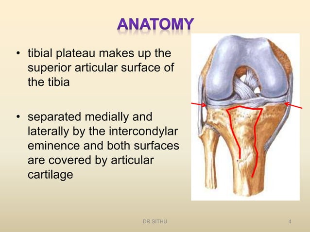 Tibial plateau fracture management .pptx | Death, Injury, or Military ...