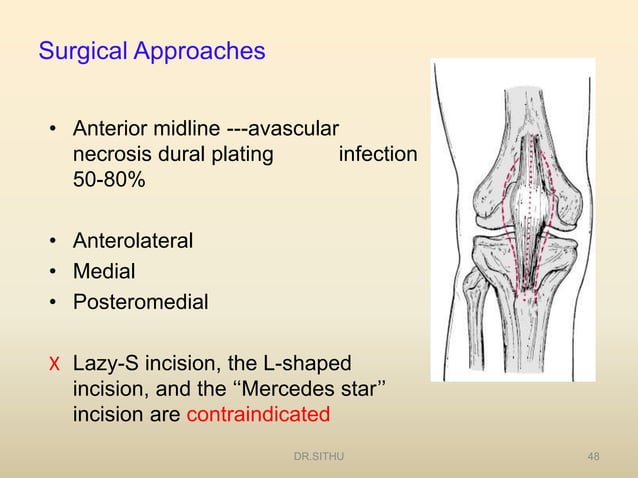 Tibial plateau fracture management .pptx | Death, Injury, or Military ...