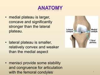 Tibial plateau fracture management .pptx