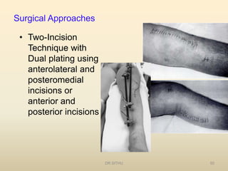 Tibial plateau fracture management .pptx