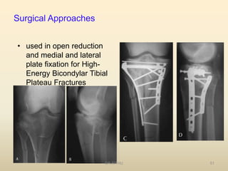 Tibial plateau fracture management .pptx